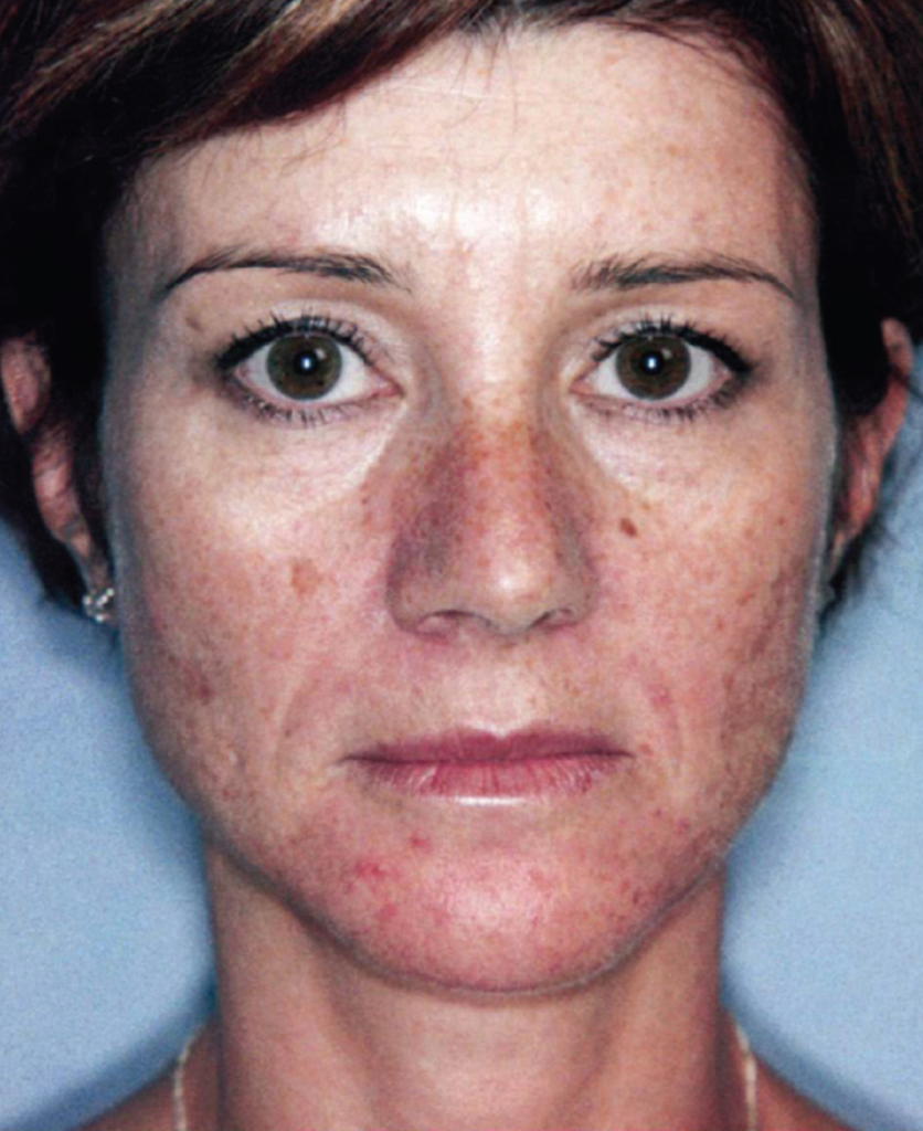 IPL (Intense Pulsed Light) - Mid Florida Dermatology & Plastic Surgery